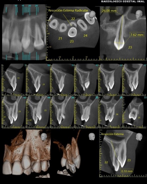 Supernumerario – Reabsorción radicular - Rado